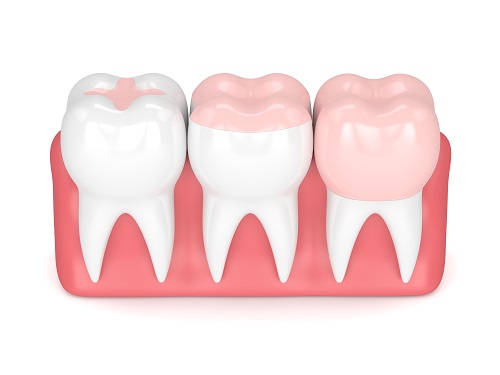 Emax Crowns: Aesthetic and Metal-Free Dental Restorations